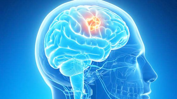 脑肿瘤切除术的微创模拟视频,看完有信心了!