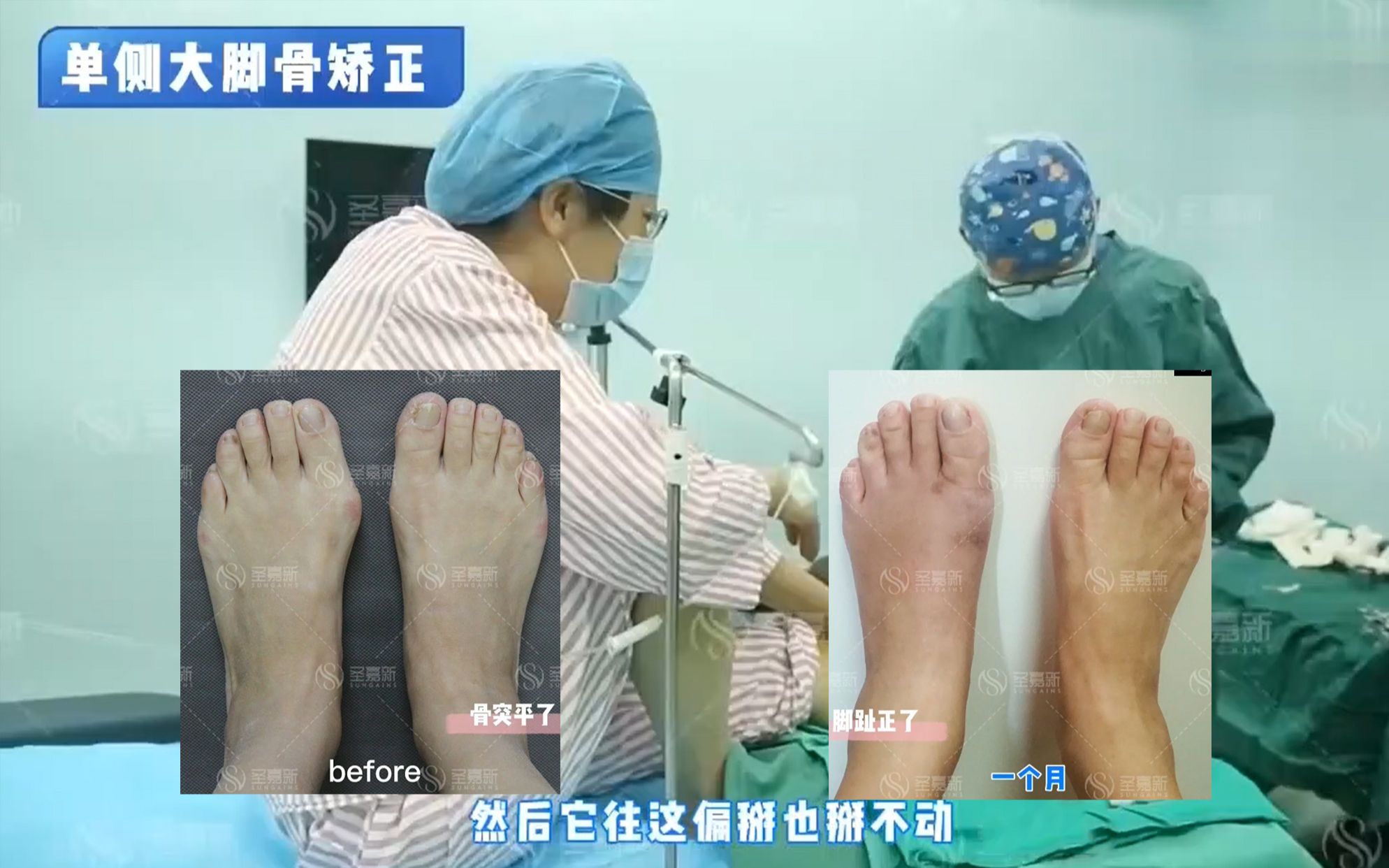 【苏敬达】单侧大脚骨拇指外翻矫正,年纪越大越严重