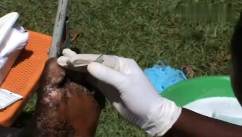 医生在清理沙蚤患者前都先用消毒水清洗一番,戴上手套后方能工作