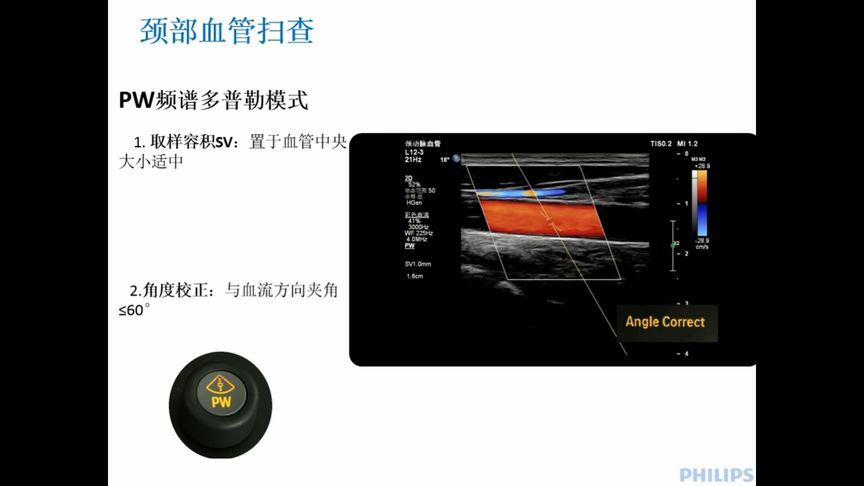 飞利浦超声-腹部浅表血管-颈部血管扫查