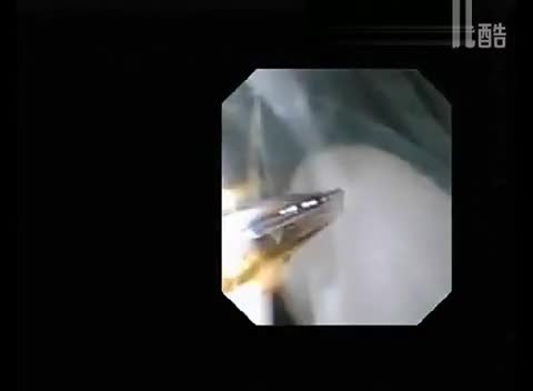 输尿管软镜钬激光碎石术-术者:复旦大学附属中山医院 徐志兵