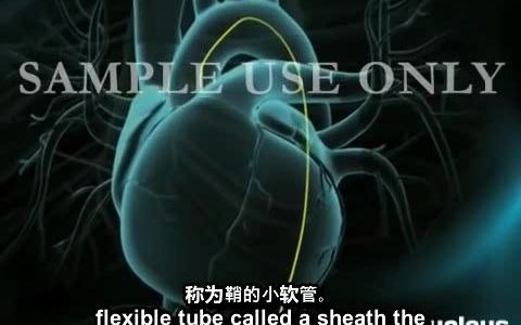 冠状动脉造影是怎么回事?