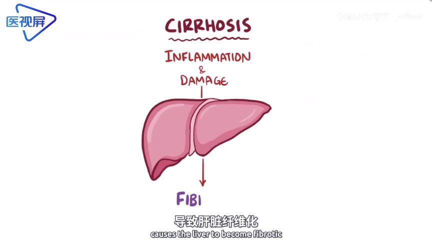 肝硬化是怎么造成的(六)#医学 #肝脏 @医视屏 @医视屏-医事