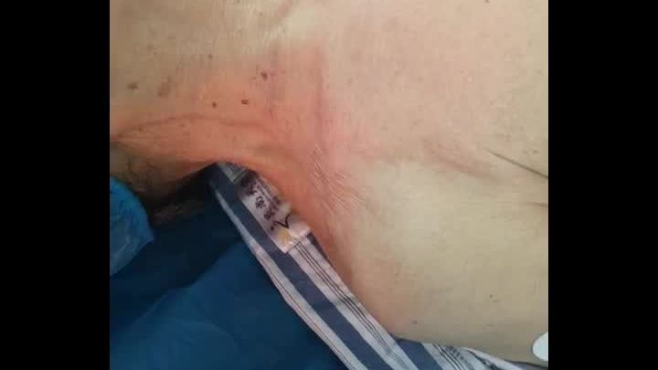 颈内静脉静脉置管高清视频