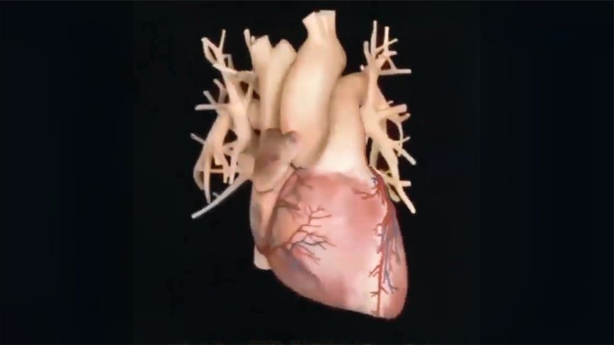 医学3D动画演示:冠状动脉粥样硬化是如何形成的?