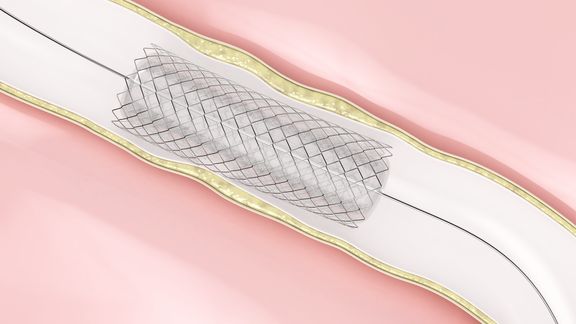 血管堵塞,支架术后如何避免二次发作风险?中医为你解答