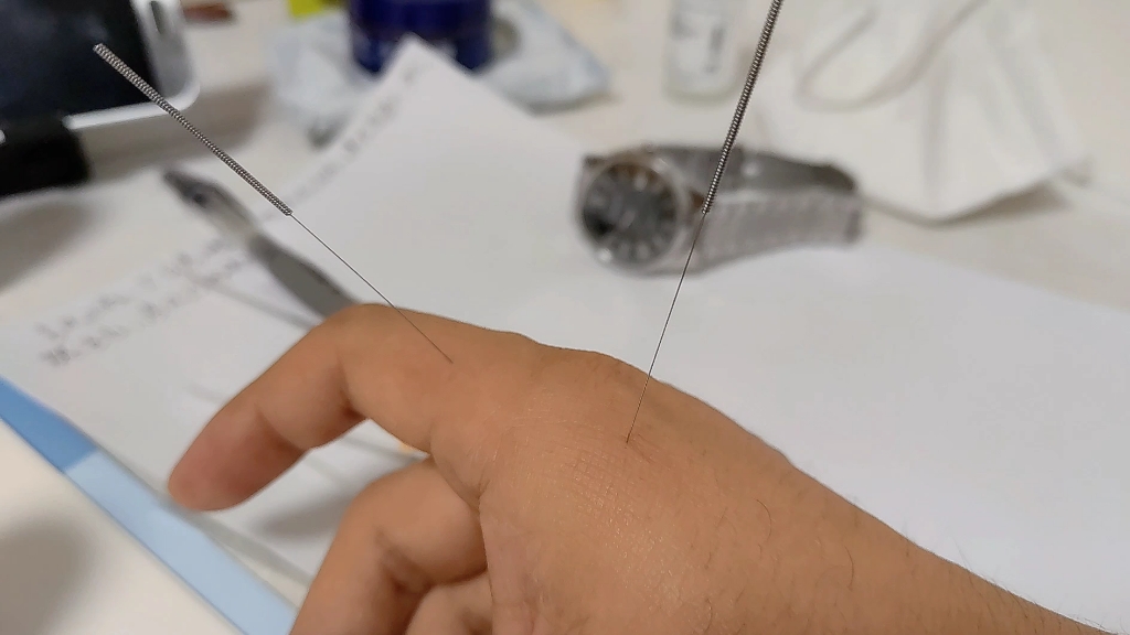 针刺二间穴和三间穴