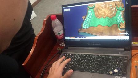 exocad 活动支架设计(四川话版)