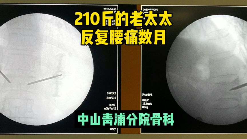 椎体成形术治疗老年骨质疏松性脊椎骨折导致慢性腰痛