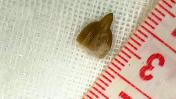 女童气管吸入半颗瓜子仁 呼吸困难生命受威胁