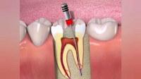 牙医科普,动画演示什么是杀神经根管治疗