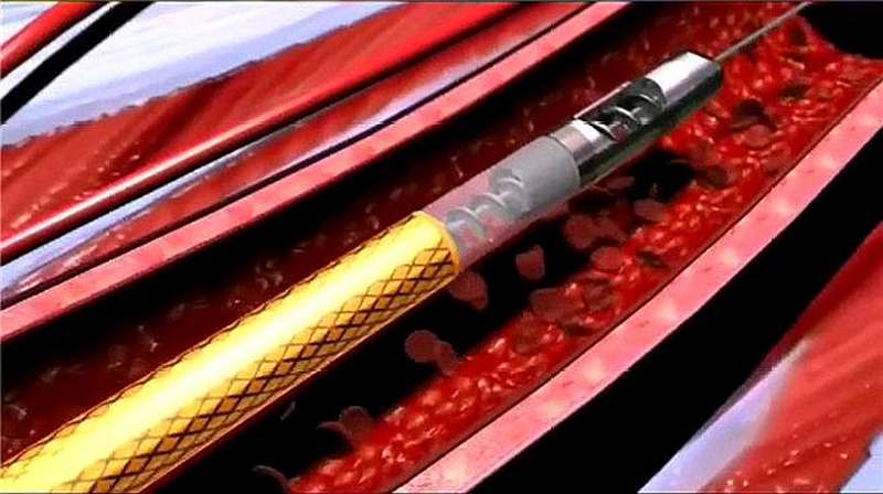 如何治疗动脉粥状硬化?这手术操作,对医生来说是个考验!