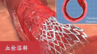 心脏血管支架手术3D动画演示