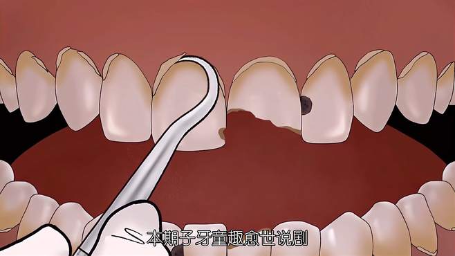 牙齿断了怎么修补?强迫症的福音,牙齿修理全过程