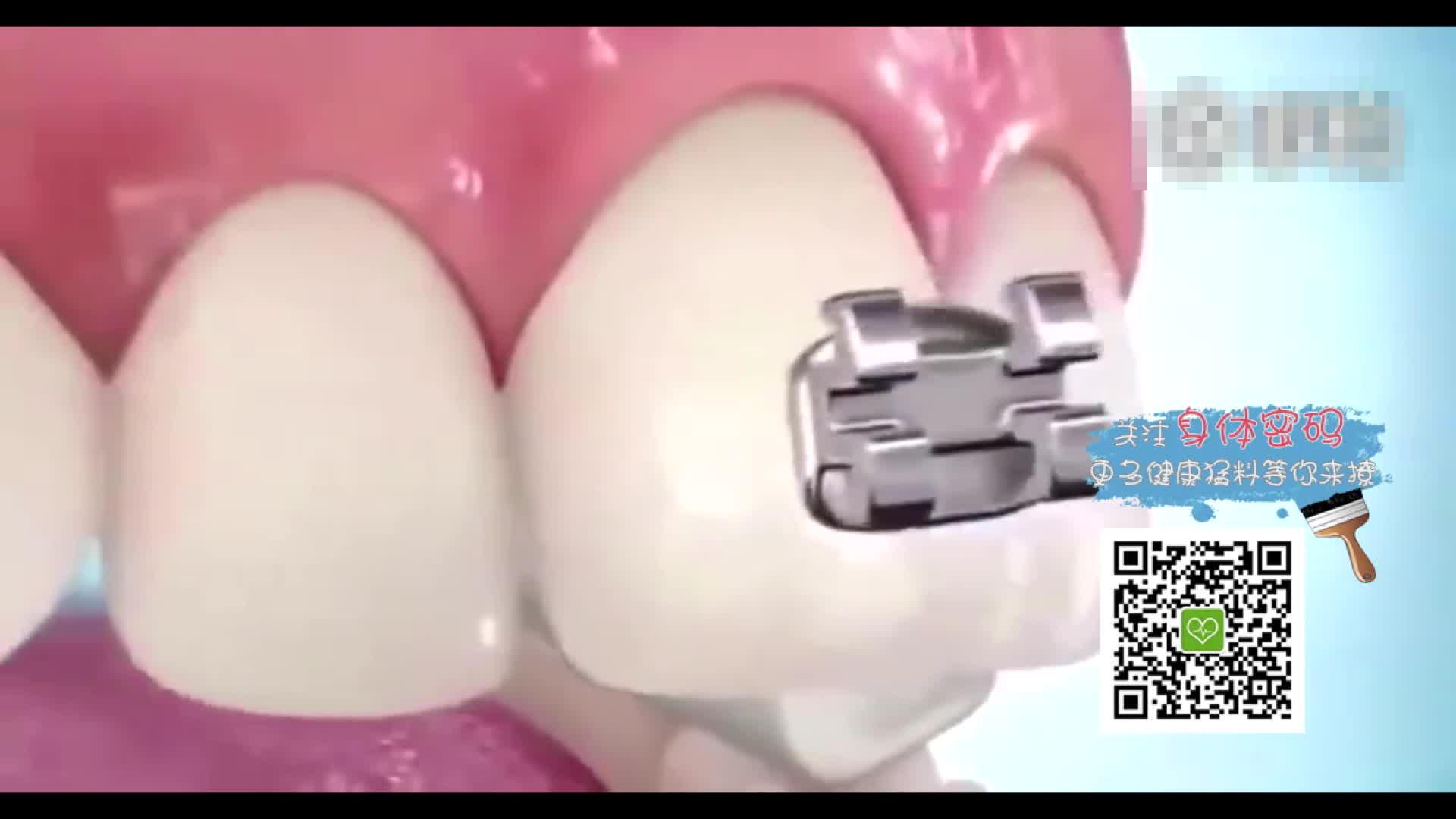 涨知识!牙齿矫正全过程