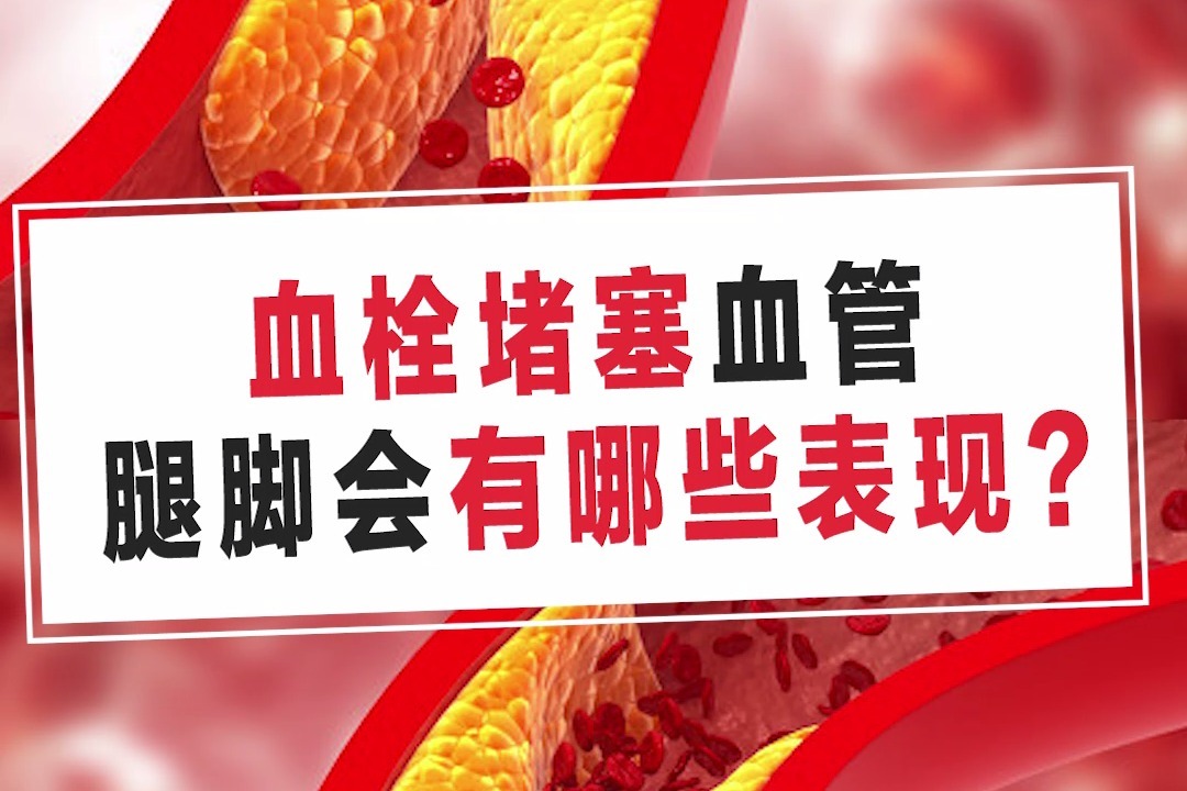 血栓堵塞血管,腿脚会有哪些表现?