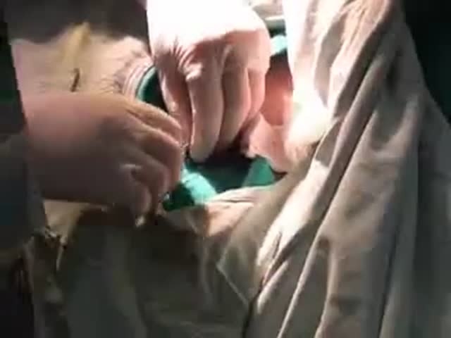永久性心脏起搏器置入术