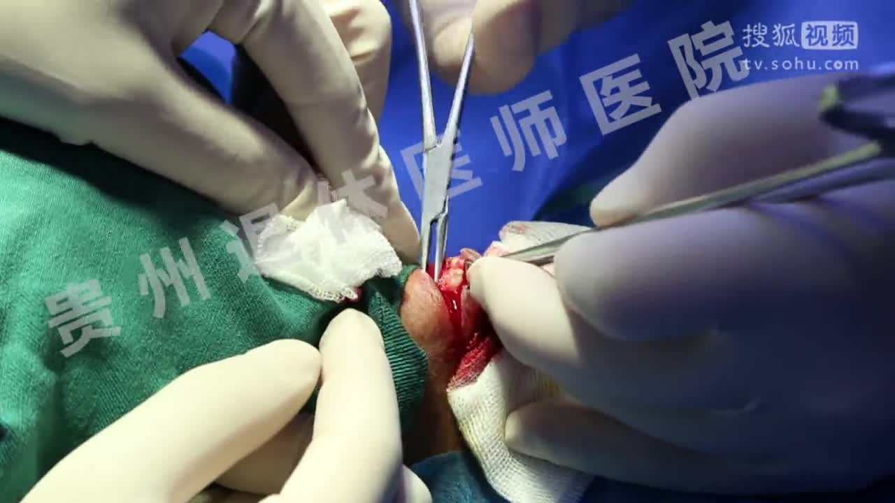 皮下囊肿手术