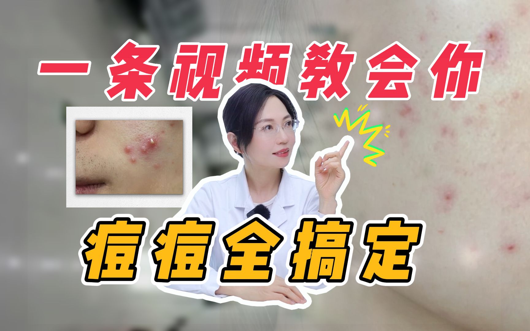 【科普】皮肤科医生|教你脸上长痘痘怎么办?