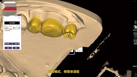 EXOCAD设计中发现少建一颗缺失牙添加教程