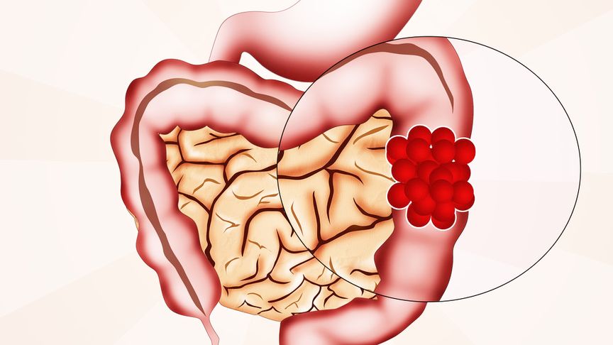 大便干、便血、腹痛?可能是结肠癌来袭,看看你还满足哪些症状