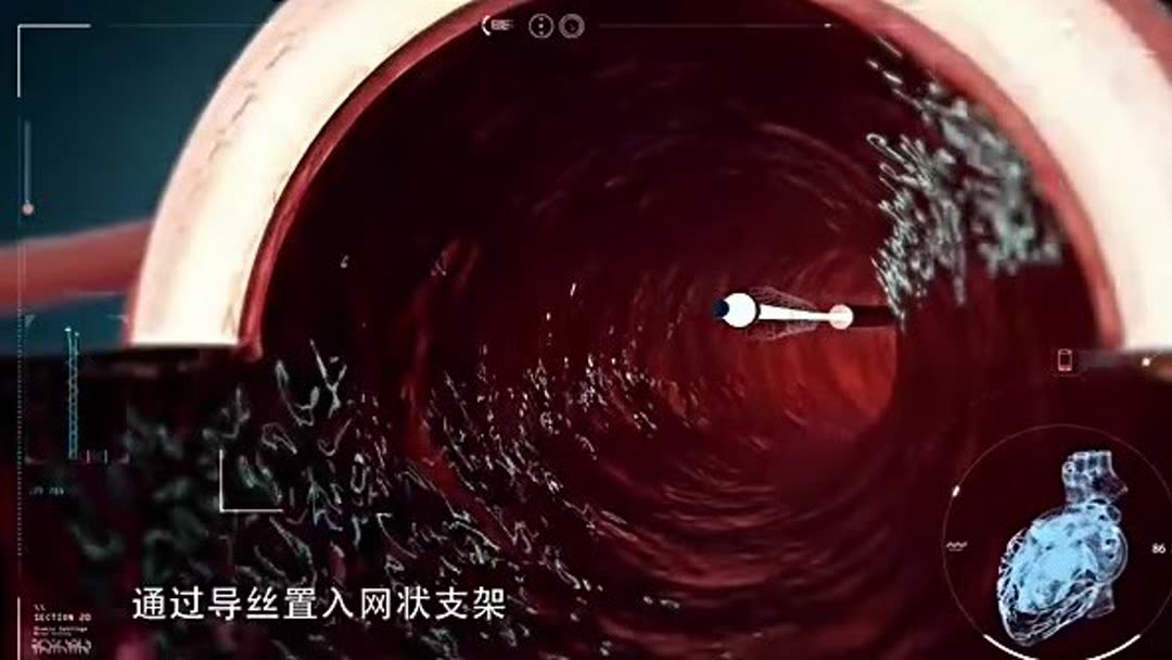 三根血管两根完全堵塞!生命一线 最终没能打通