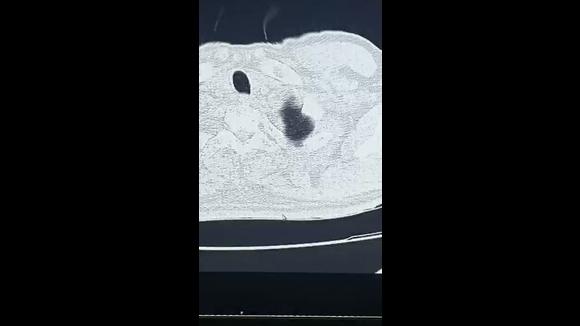 右肺下叶周围型肺癌并纵膈右肺门淋巴转移