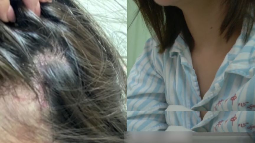 空姐打玻尿酸后长斑,又头扎200针放血治疗,致皮肤坏死头发斑秃