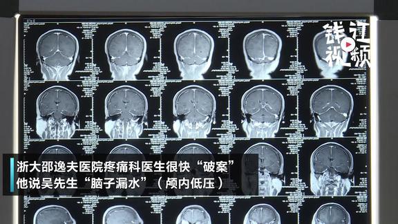 "脑子漏水"居然是真的 长期玩手机的"低头族"要小心