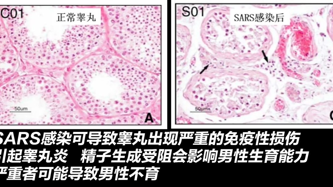 专家:新冠感染恐造成睾丸损伤 严重者可能导致不育