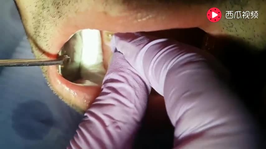 牙齿根管治疗实录, 看完你还敢得牙病吗?根管治疗术又称牙髓治疗,是...