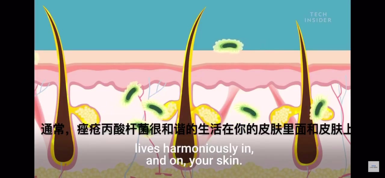 痘痘的形成原因!_在国外网站上看到这个关于痘痘形成原因的小动画!...