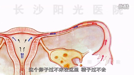 【专家讲堂】输卵管性不孕 长沙阳光医院 0731-85813999