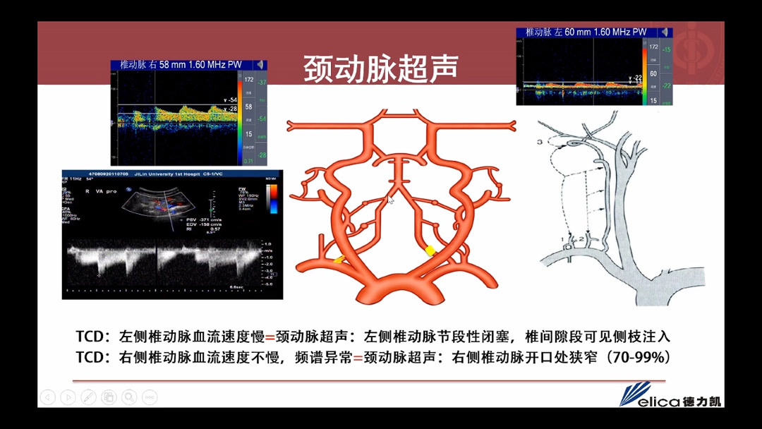 第十一期-韩珂:头颈部血管超声助力神经科医生拨云见日