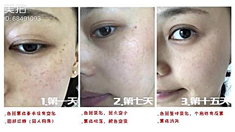 美拍视频: 超皮秒经历分享! #时尚#
