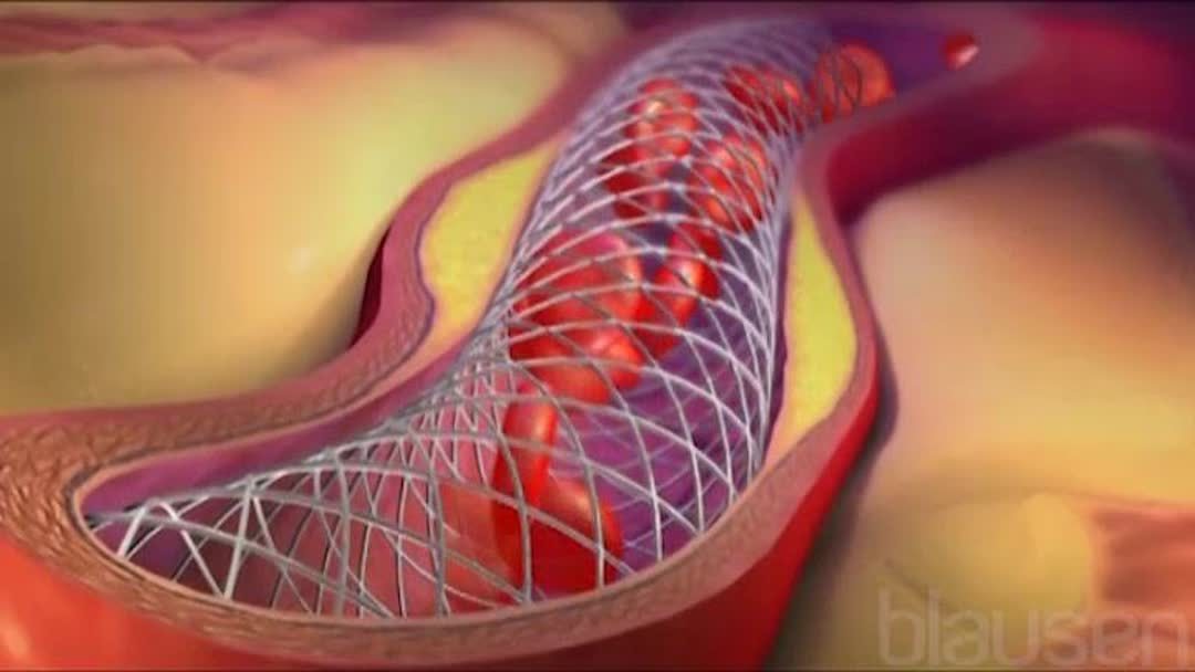 医学3D动画演示:冠状动脉狭窄介入成形术、支架植入术