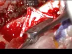 微血管减压术的技术细节-2D(Neurosurgery Journal)