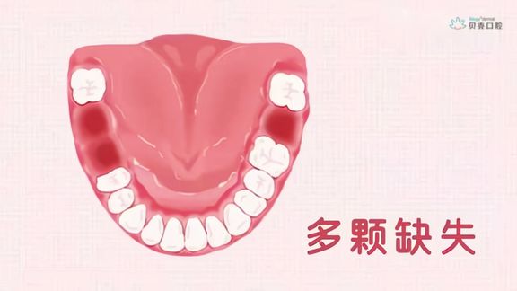 提前算一算,种植牙需要多少钱呢?