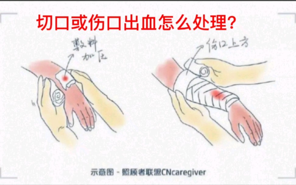 切口或伤口出血怎么处理?