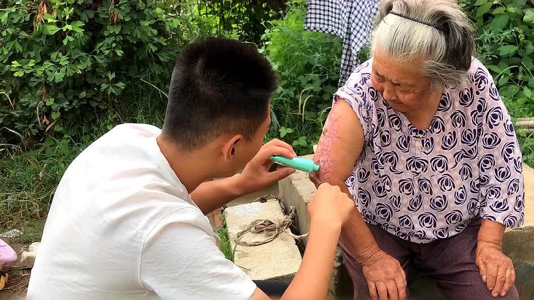 村里奶奶被大火烧伤,每天就涂一些双氧水,连医院都不舍得去
