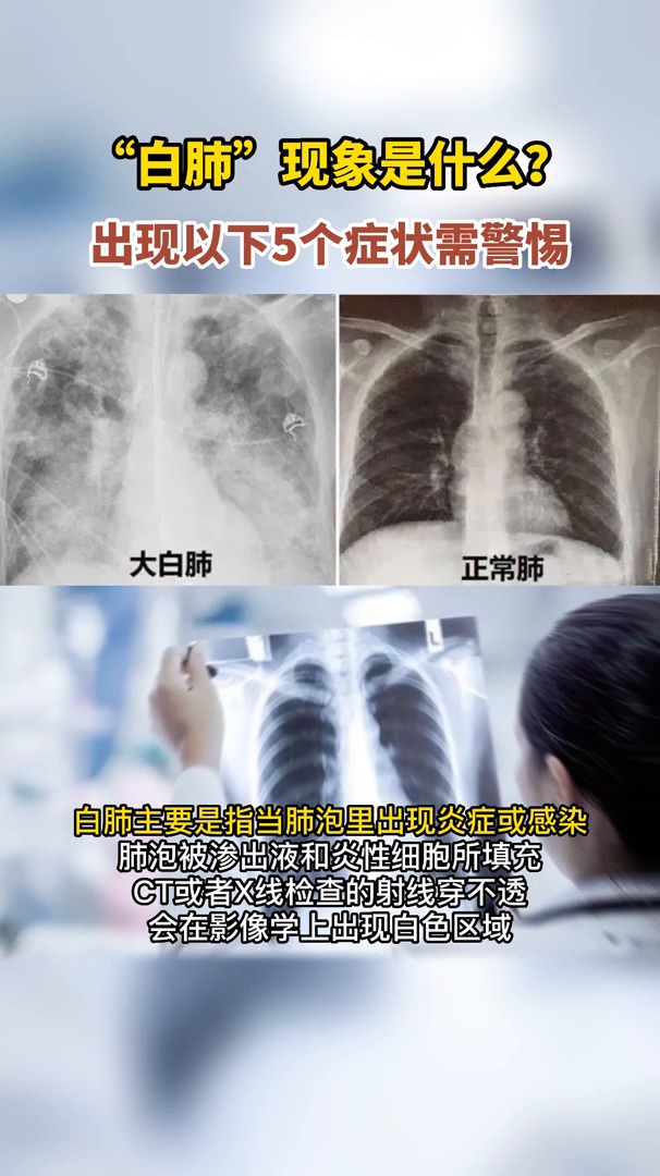 新冠确诊后应采取早治疗早干预措施,STC314注射液作为重症特殊用药,...