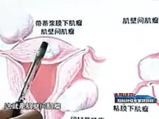 输卵管堵塞的治疗方法