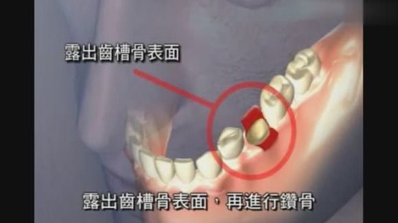 种植牙的全过程动画,了解清楚再考虑要不要做