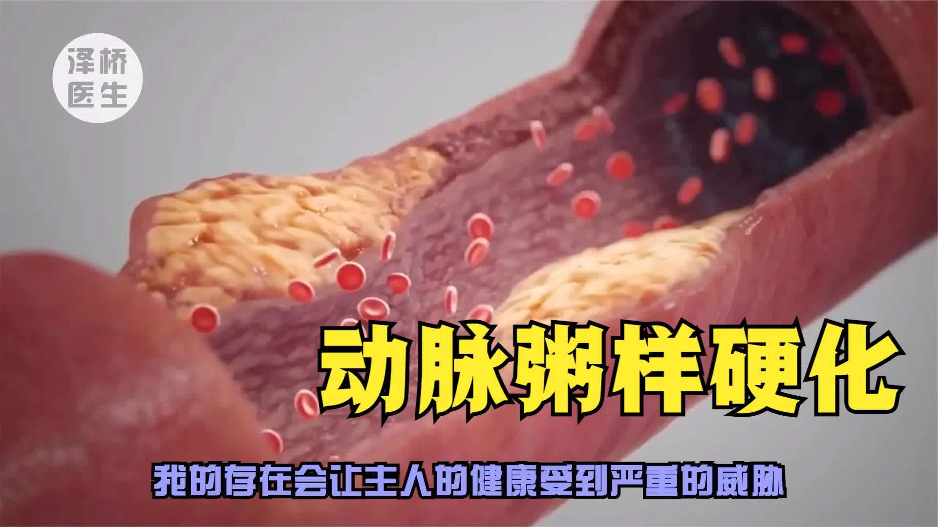 影响动脉粥样硬化形成的最关键因素是"它"!真是疏不得,防不胜