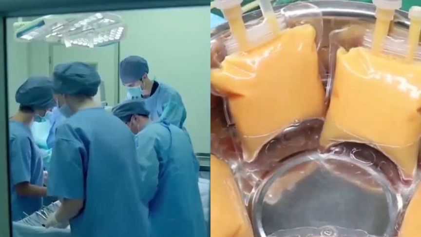 女子胸部取出800毫升"奶茶":20年前做假体隆胸破裂后游离体内