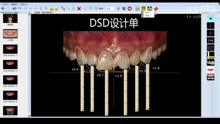DSD数码微笑设计演示 金堂大学城迎国际尖端牙科技术