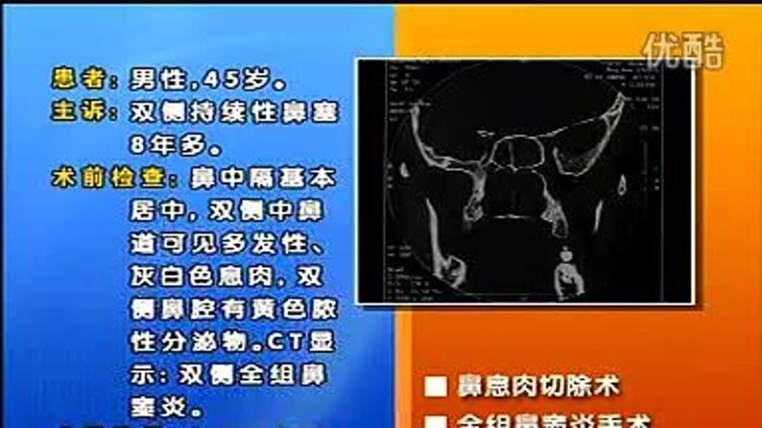 鼻息肉切除术全组鼻窦切开术