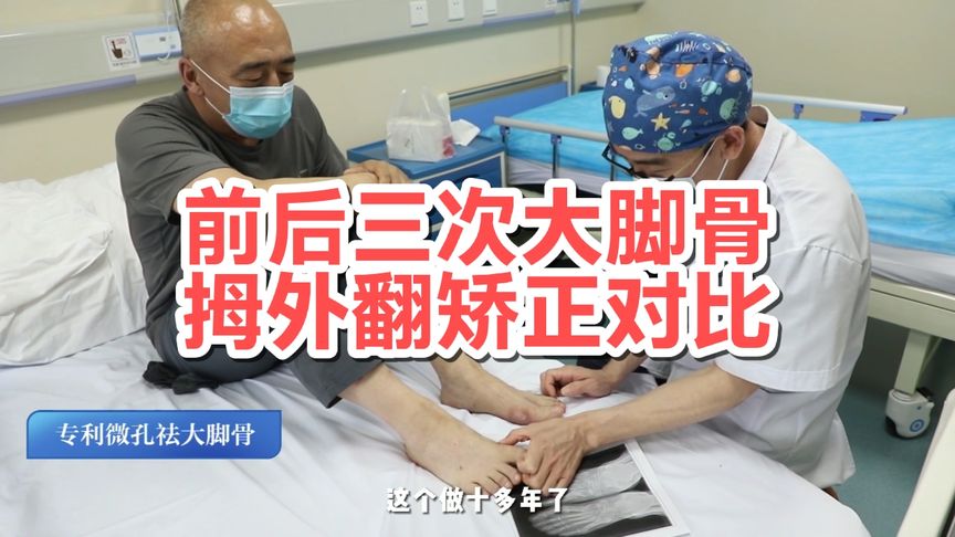 前后三次大脚骨拇外翻矫正对比