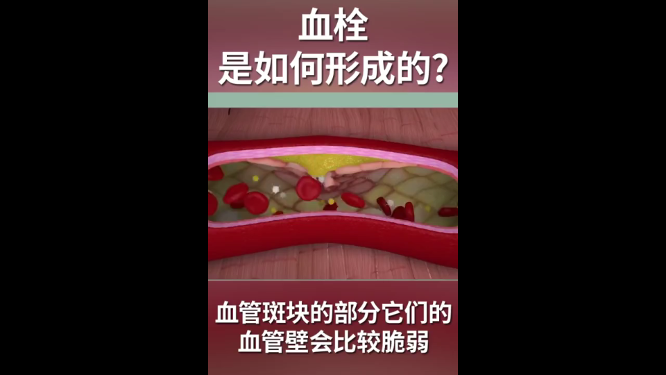 血栓的形成以及中风小科普