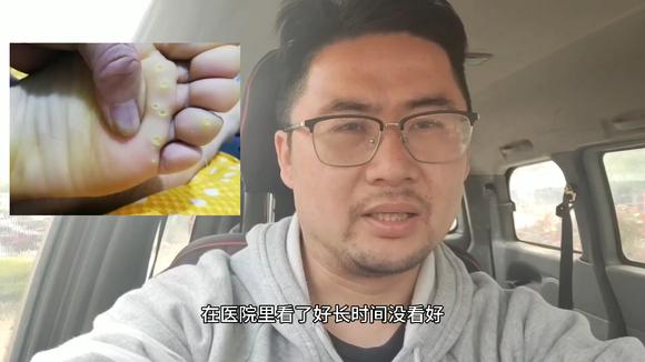 微商大姐五百元药膏,治愈我半年的趾疣,还给我六千窗元帘订单!